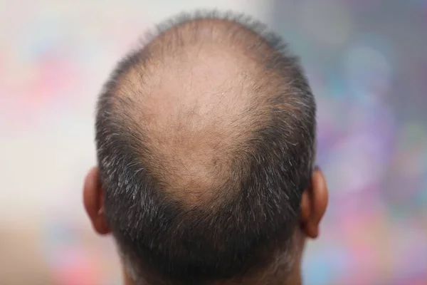 Baldness before after Stock Photos, Royalty Free Baldness before after ...