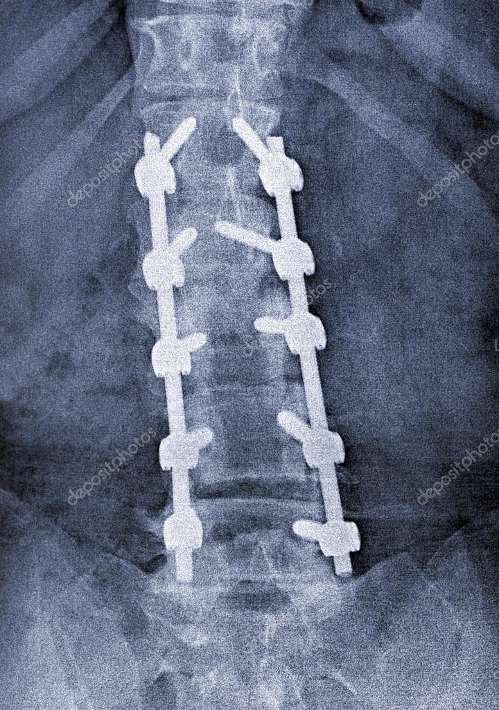 Spondylolisthesis - Stock Image Stock Photo by ©alexisdc 32323629