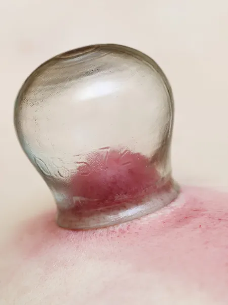 263 Fire cupping Stock Photos, Fire cupping Images | Depositphotos®