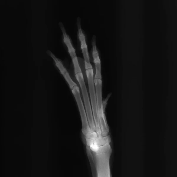 Splint Stock Photos, Royalty Free Splint Images | Depositphotos