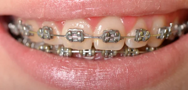 Teeth side view | Side view of dental braces on teeth close up — Stock ...