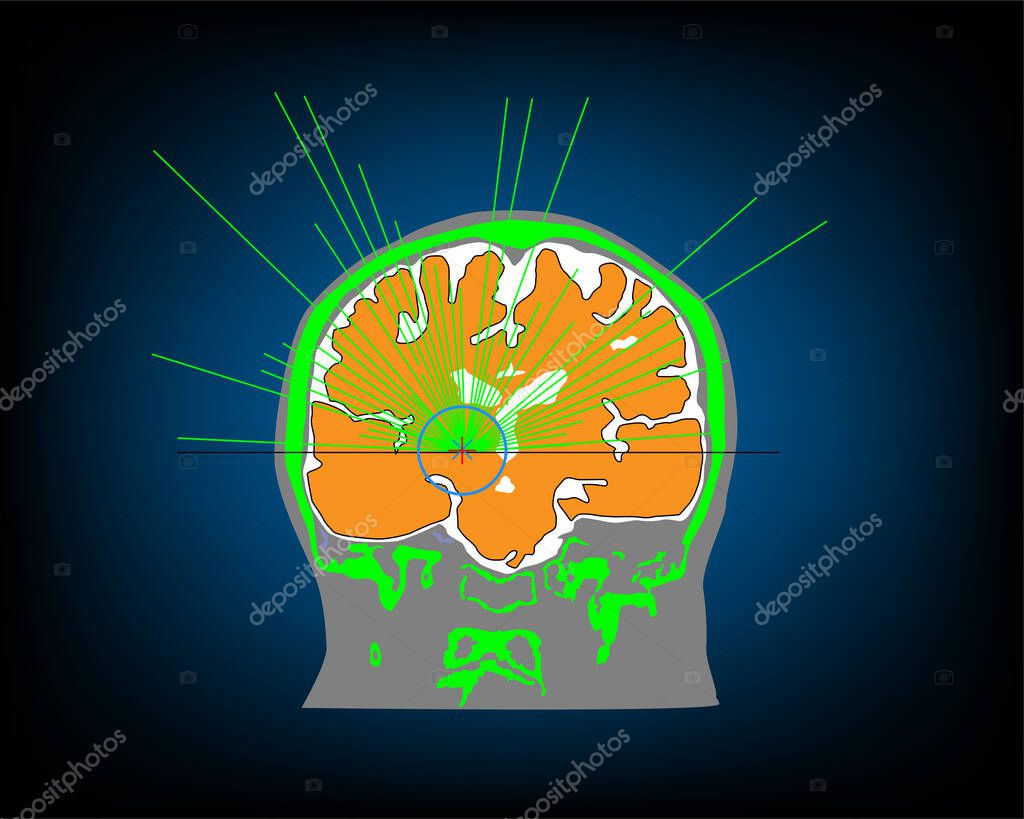 Ilustración de ultrasonido focalizado guiado por resonancia magnética ...