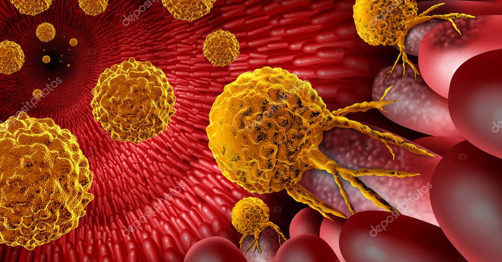 Concepto de anatomía del cáncer de intestino interno como el ...