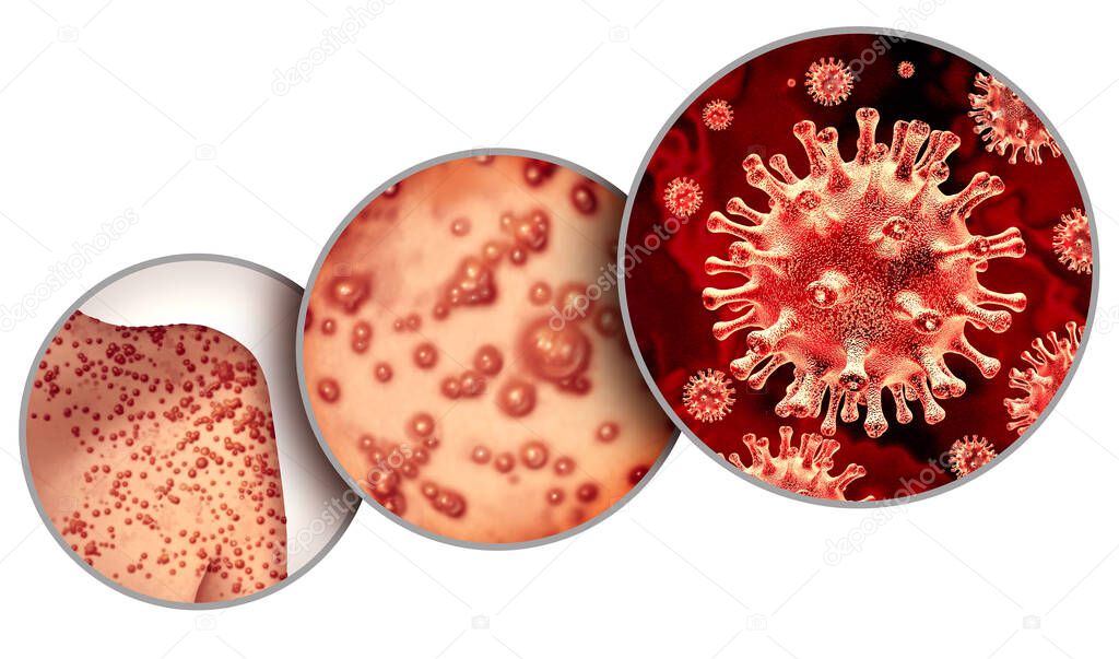 Brote de Virus de la Monkeypox como una infección contagiosa como ... Brote de Virus de la Monkeypox como una infección contagiosa como ...