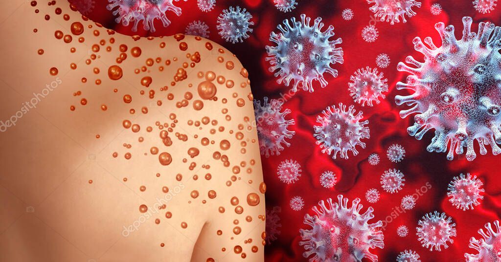 Brote de Virus de la Monkeypox como una infección contagiosa como ... Brote de Virus de la Monkeypox como una infección contagiosa como ...