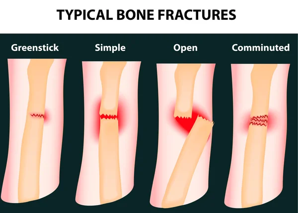 Bone fractures images vectorielles, Bone fractures vecteurs libres de ...