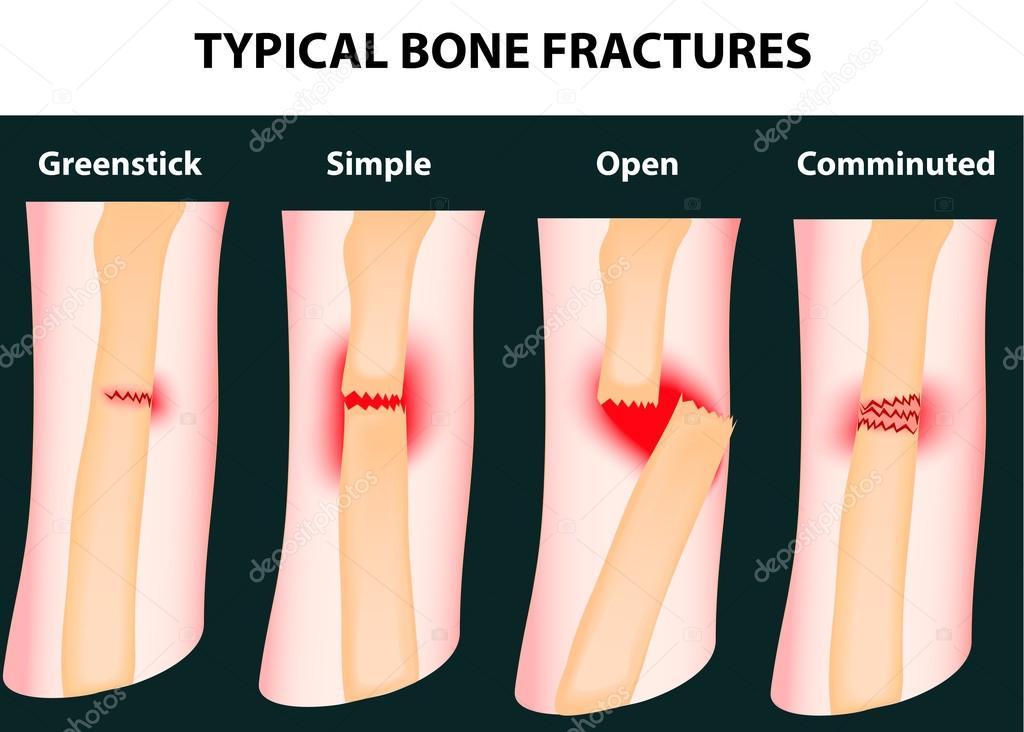 Typical bone fractures — Stock Vector © edesignua #14262625 Typical bone fractures — Stock Vector © edesignua #14262625