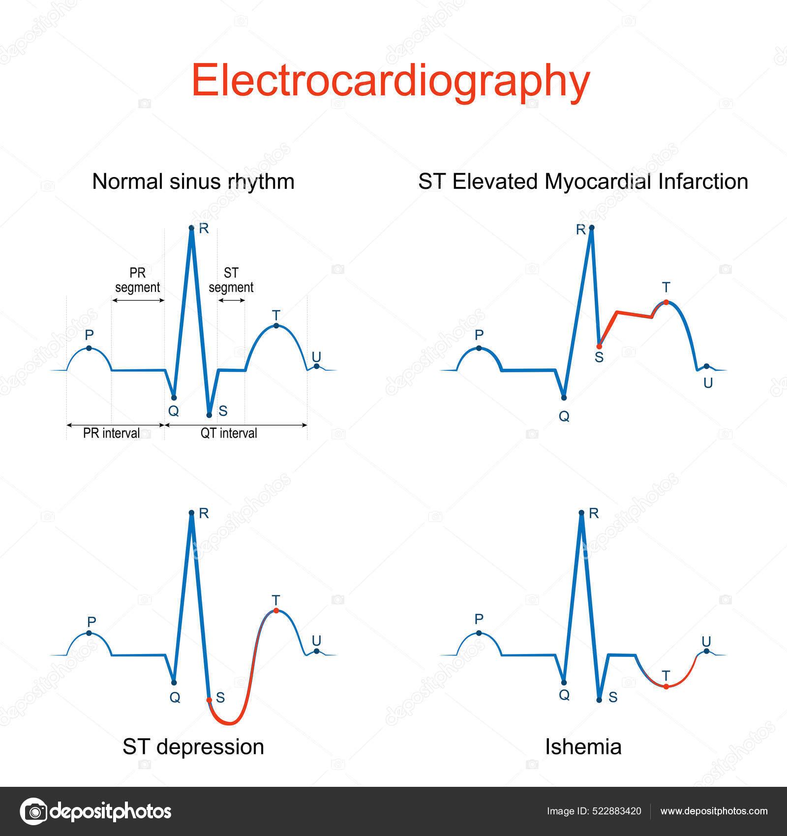 Electrocardiography Ecg Ekg Heart Normal Sinus Rhythm Elevated ...