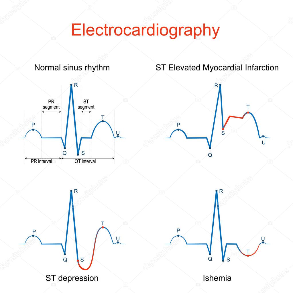 Electrocardiografía. ECG o ECG de un corazón con ritmo sinusal normal ...