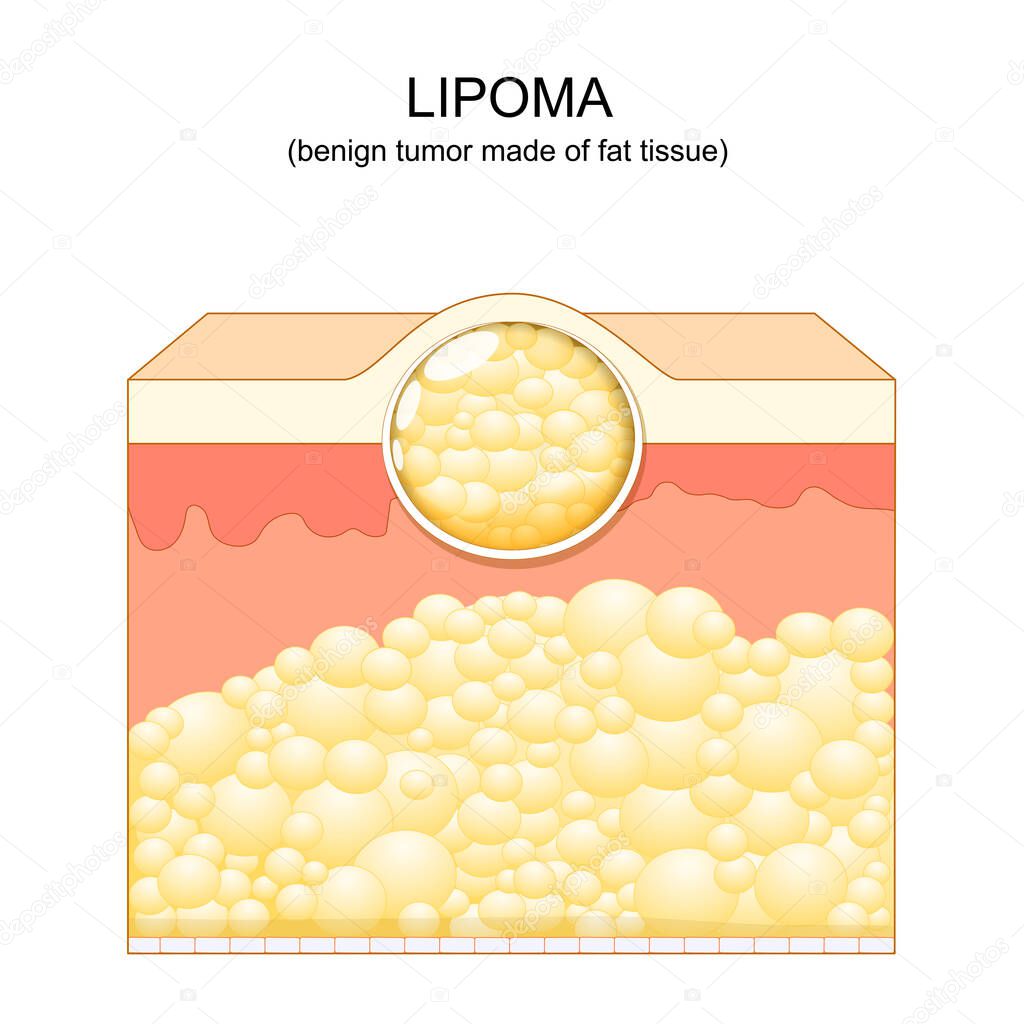Lipoma. tumores adiposos localizados en los tejidos subcutáneos de la ...