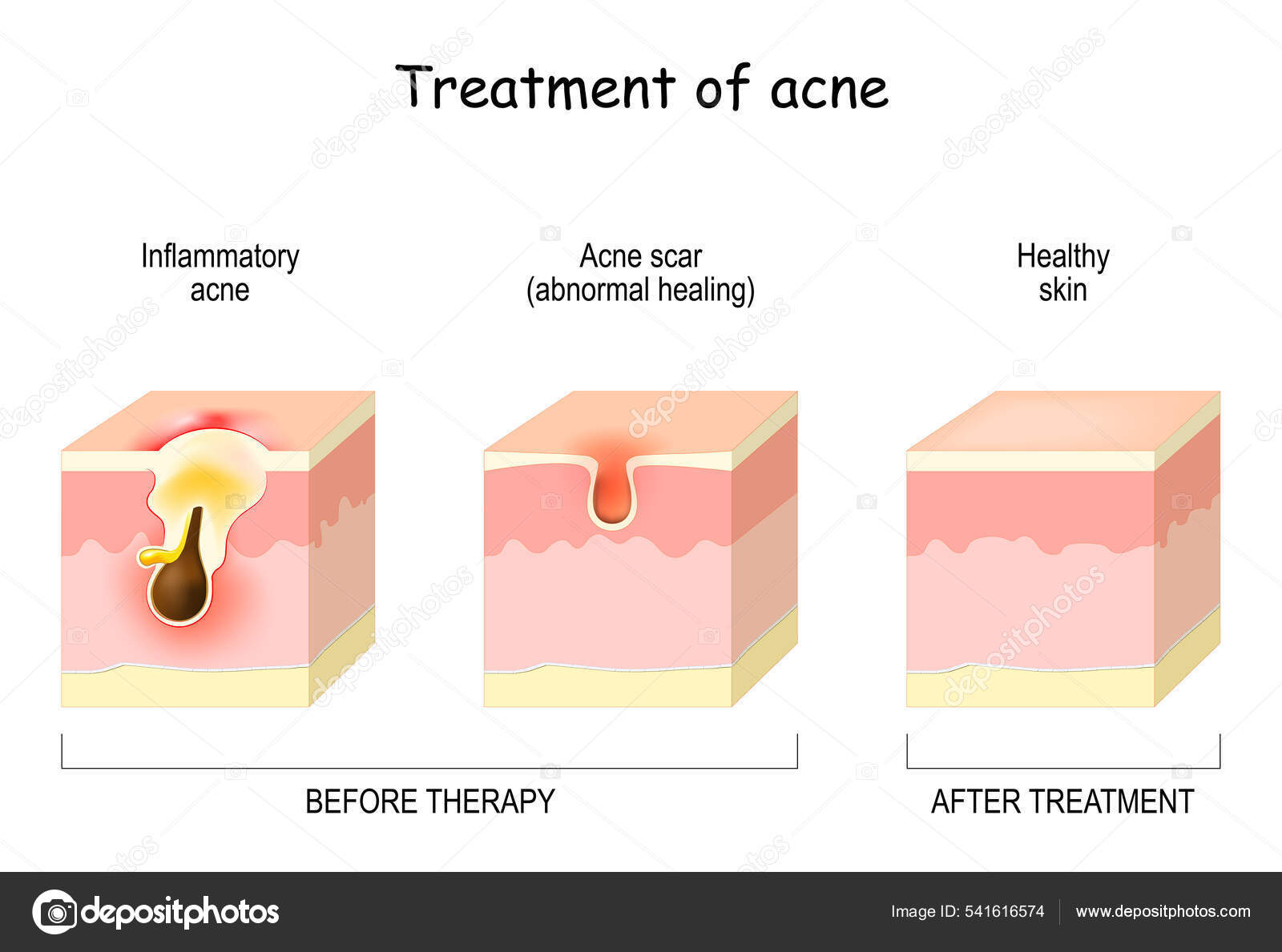 Treatment Acne Skin Layers Therapy Inflammatory Acne Scar Abnormal ...