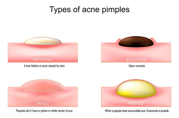 Acne vulgaris or pimple. Stock Vector by ©edesignua 144303335