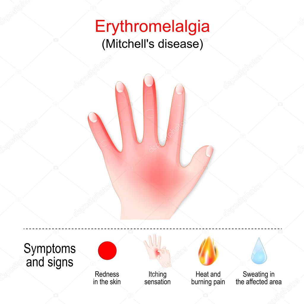 Erythromelalgia is a rare condition that causes episodes of burning ...