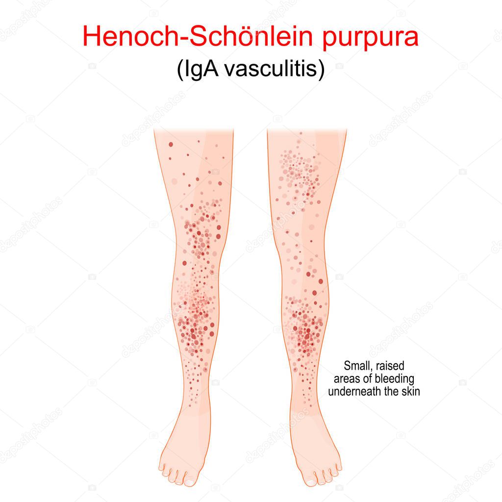 Henoch Schnlein purpura. Spotty rash on the humans legs. The spots are ...