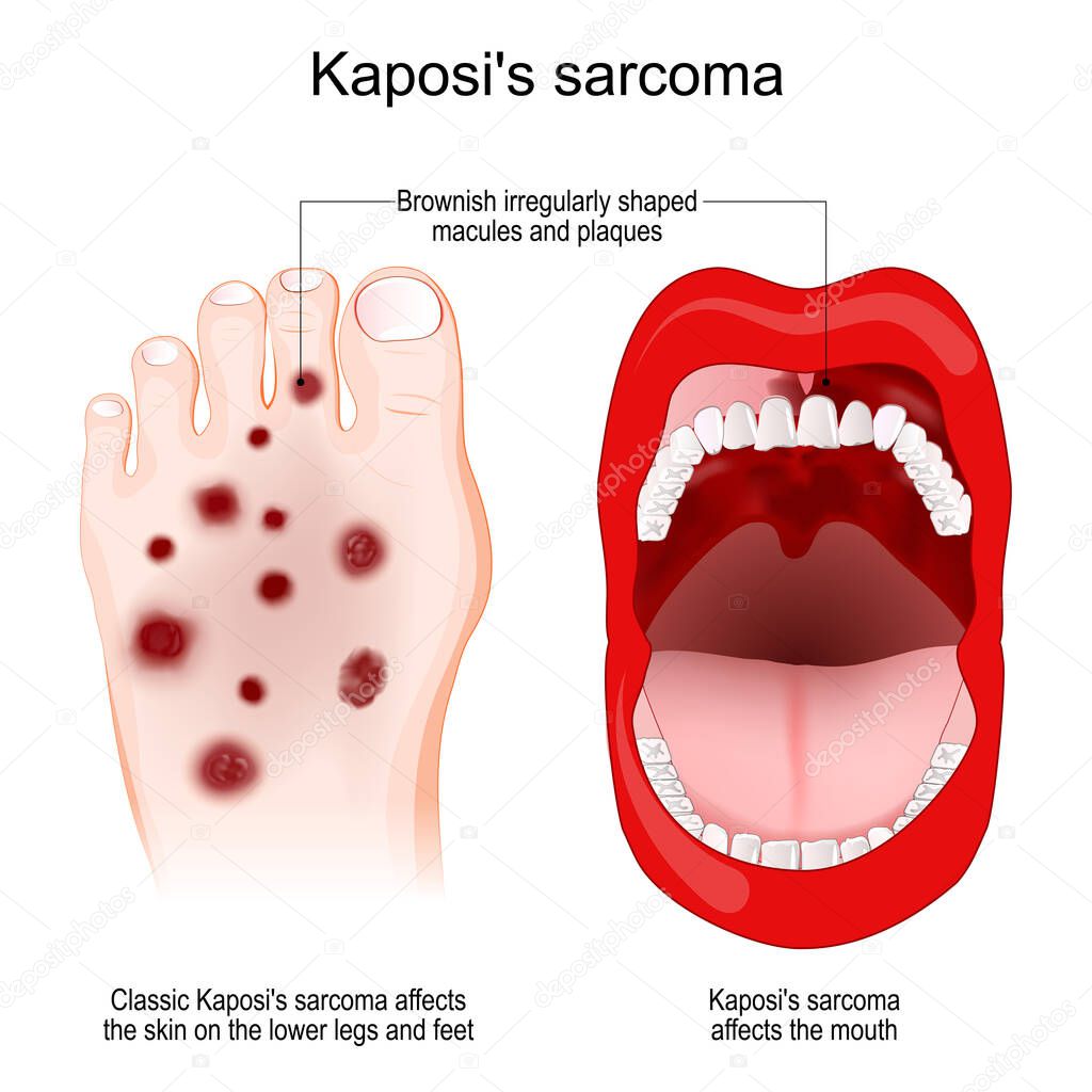 Kaposi's sarcoma is a rare type of cancer caused by infection by Human ...