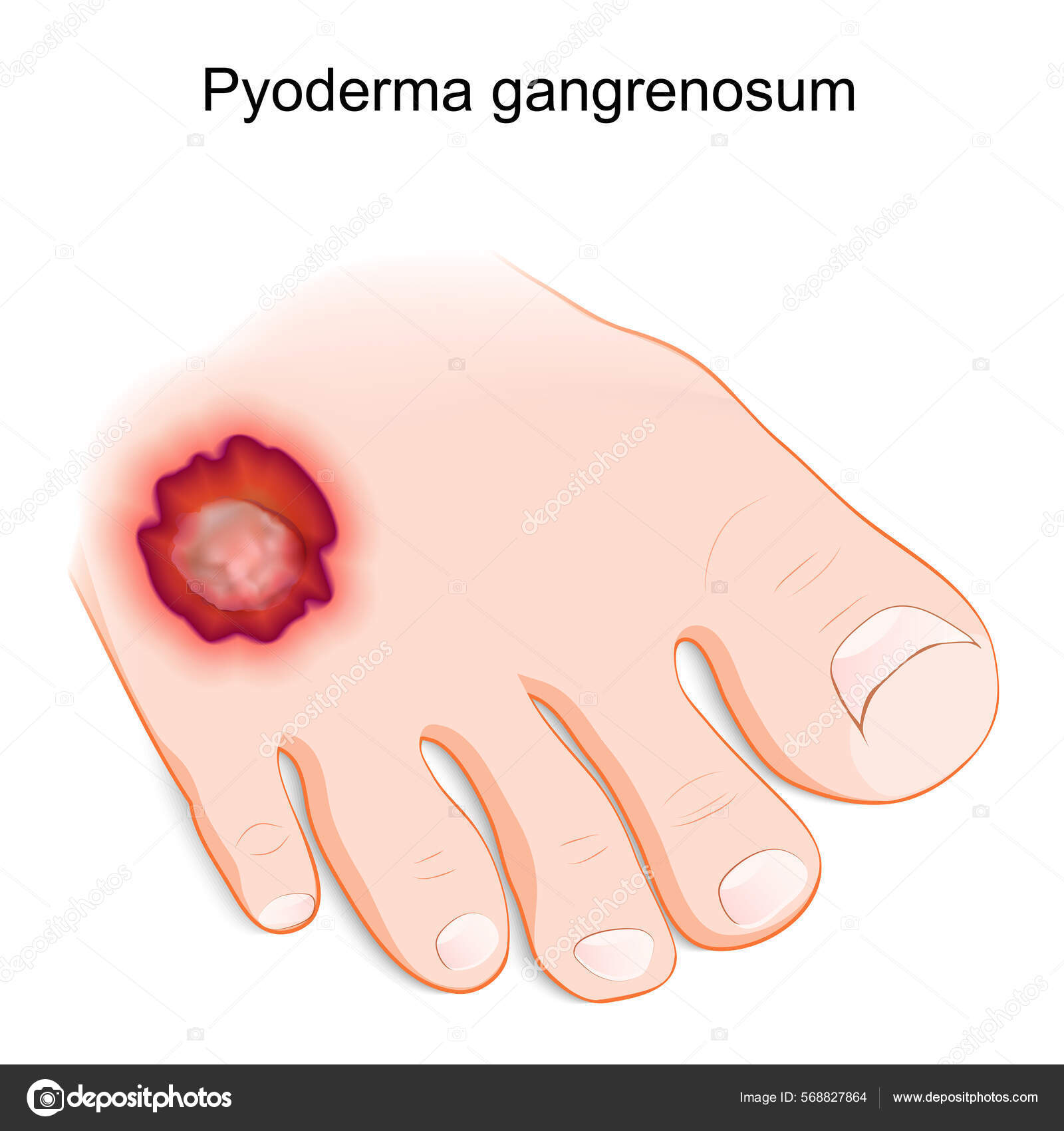 Pyoderma Gangrenosum Inflammatory Skin Disease Human's Foot Painful ...