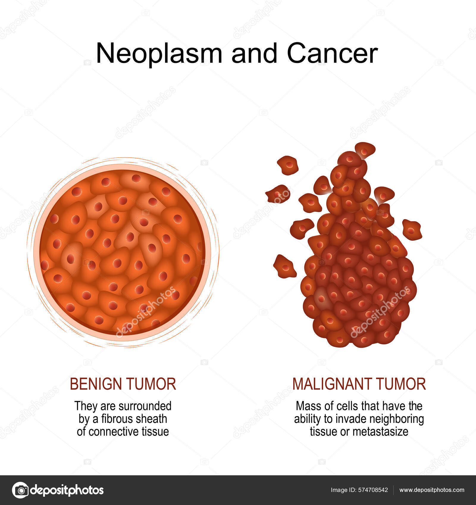Tumeur Cancer Comparaison Différence D'une Tumeur Maligne Bénigne ...