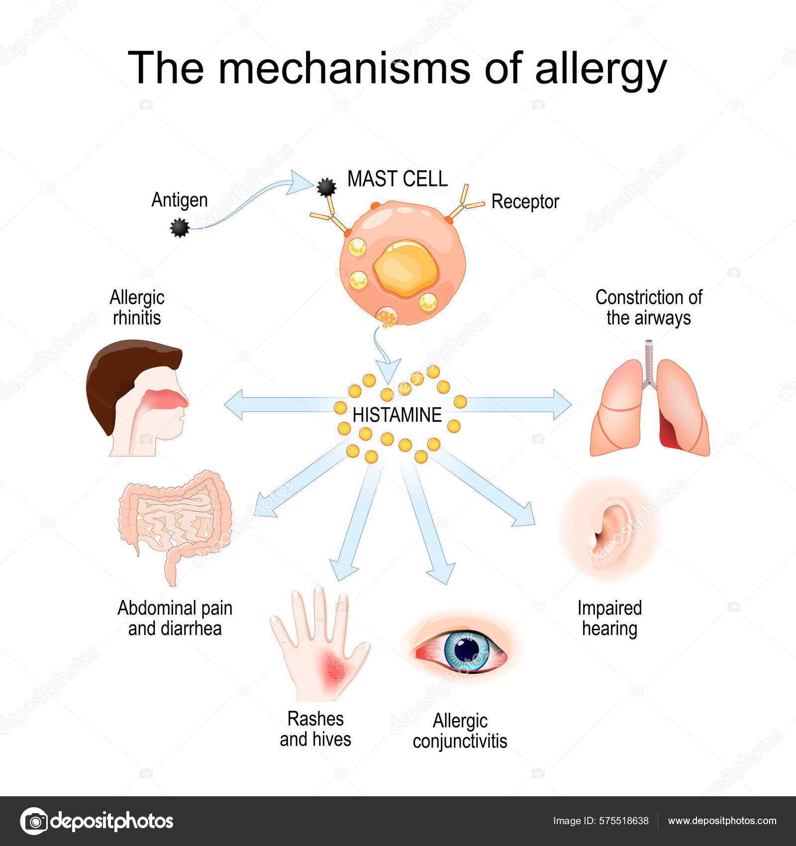 Mekanisme Alergi Sel Masa Lalu Dan Reaksi Alergi Histamin Respon Vektor ...