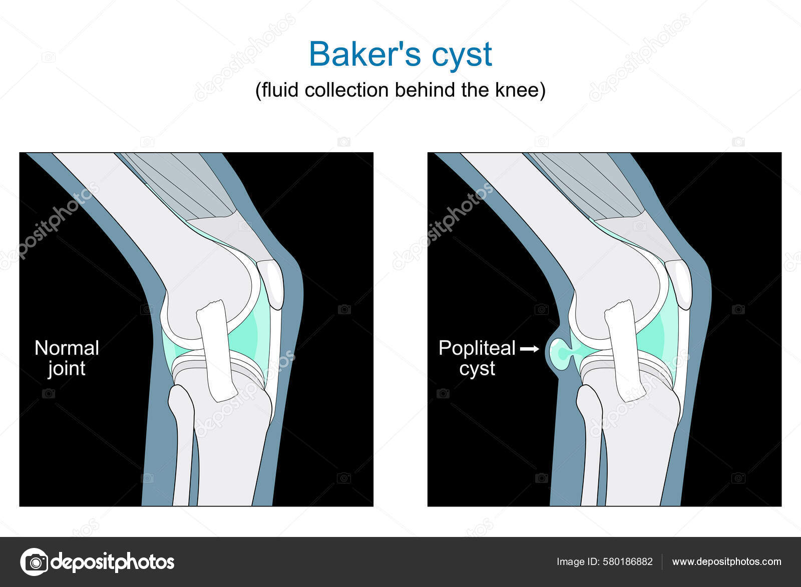 Kista Baker Cairan Koleksi Belakang Lutut Cross Section Human Joint ...