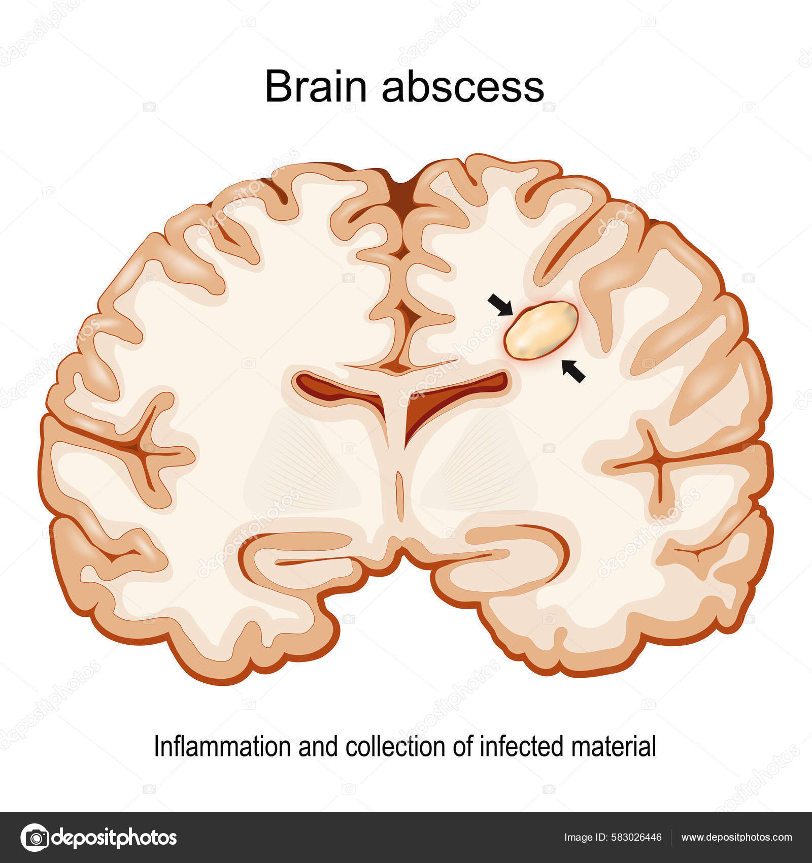 Absceso Cerebral Absceso Cerebral Enfermedades Infecciosas Del Cerebro ...