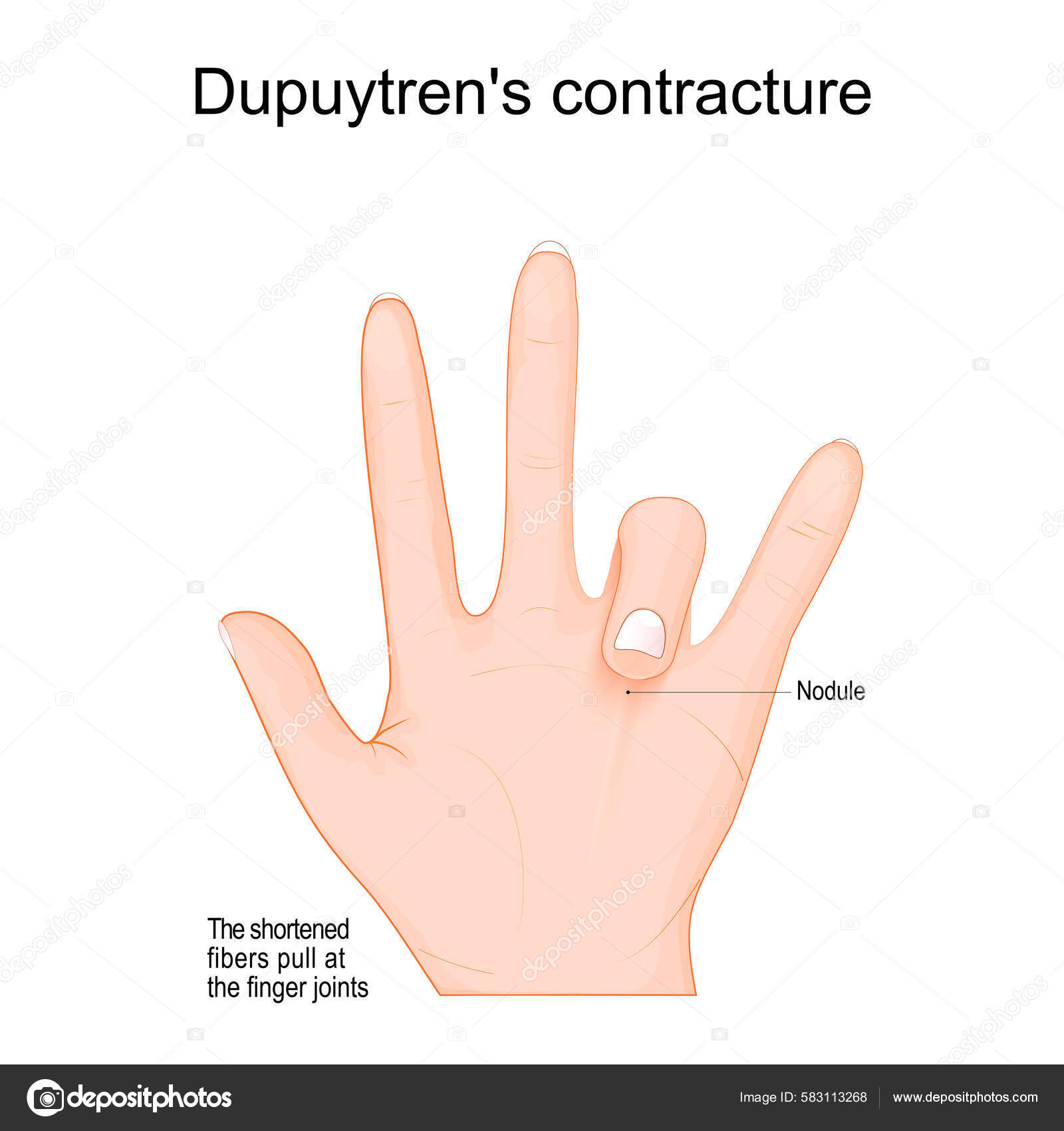 Dupuytren's Contracture Finger Bend Palm Dupuytren's Disease Left Hand ...