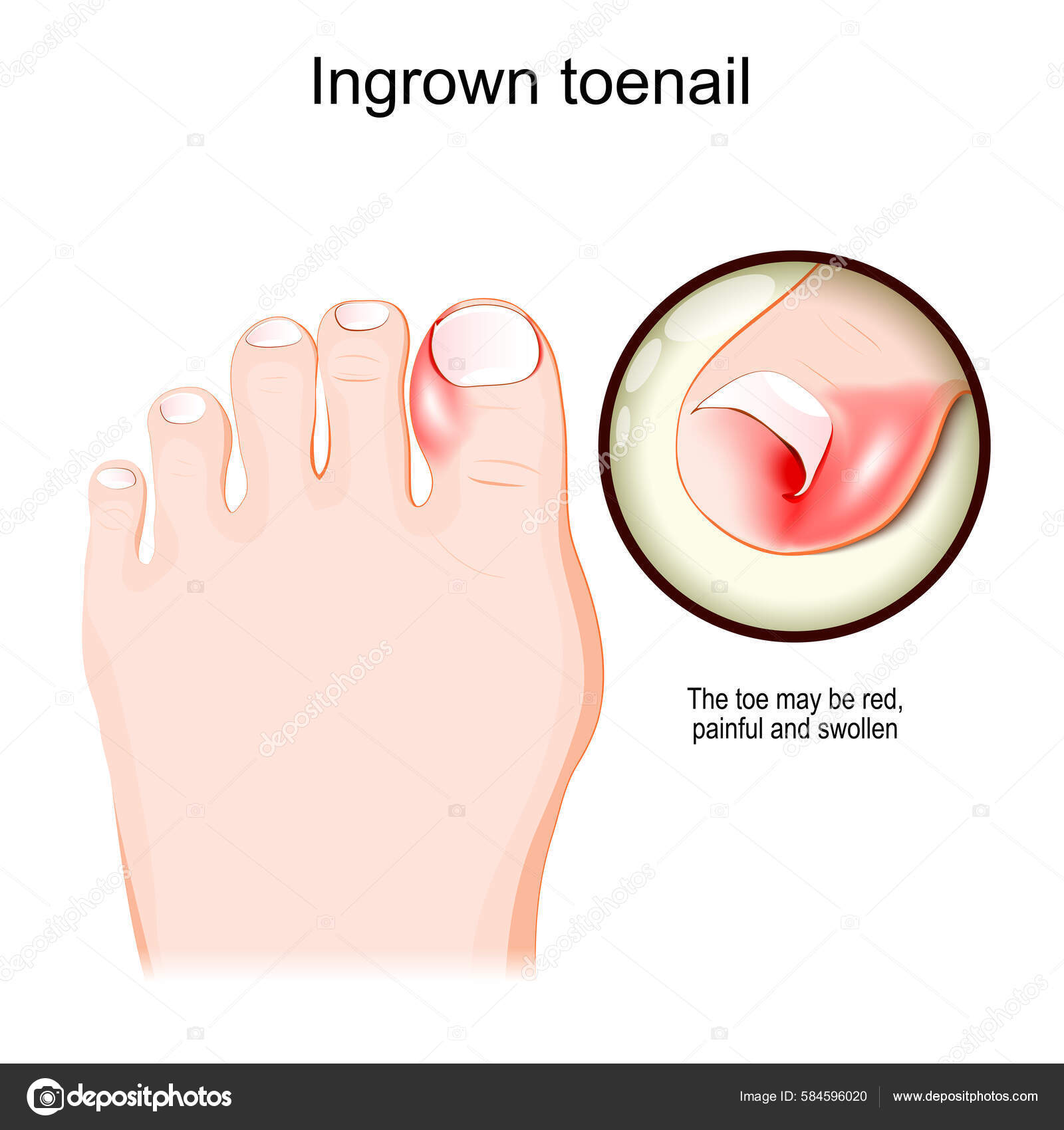 Ingrown Toenail Human Foot Close Red Painful Swollen Toe Vector Stock ...