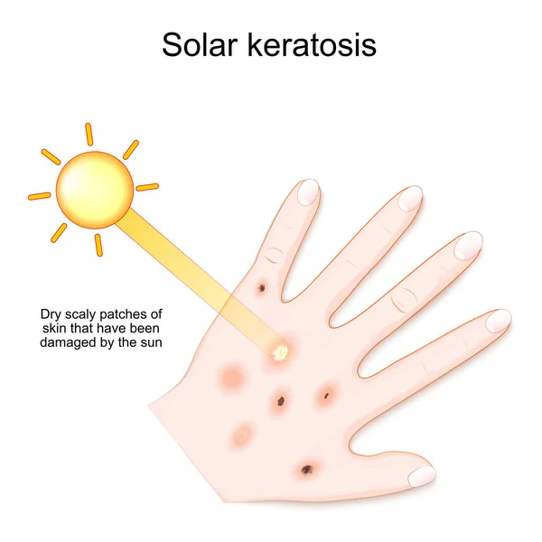 Solar keratosis. Dry scaly patches of skin that have been damaged by ...