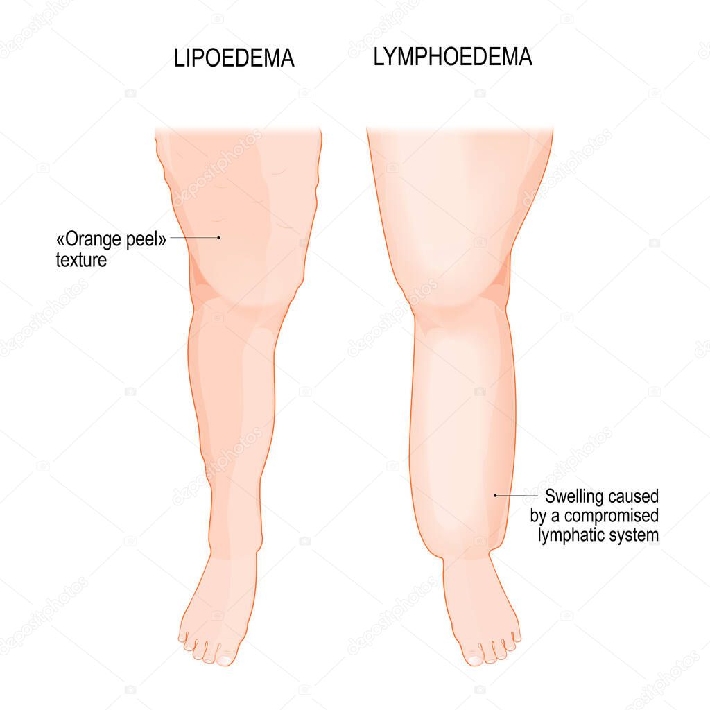 Vettoriale stockLymphedema Lipoedema Comparison Difference Lipedema Leg ...