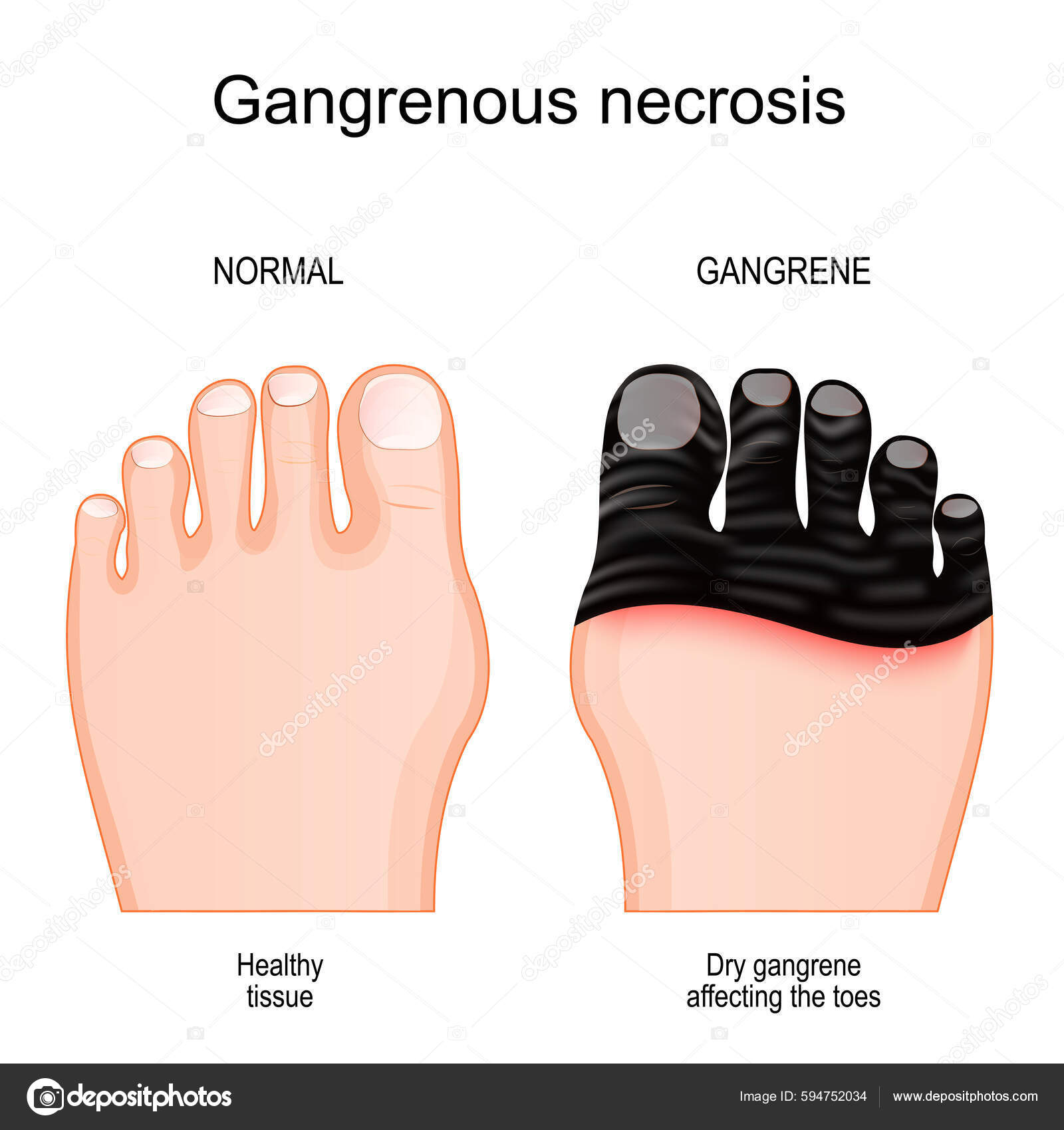 Gangrene Comparison Difference Healthy Foot Leg Tissue Death Gangrenous ...
