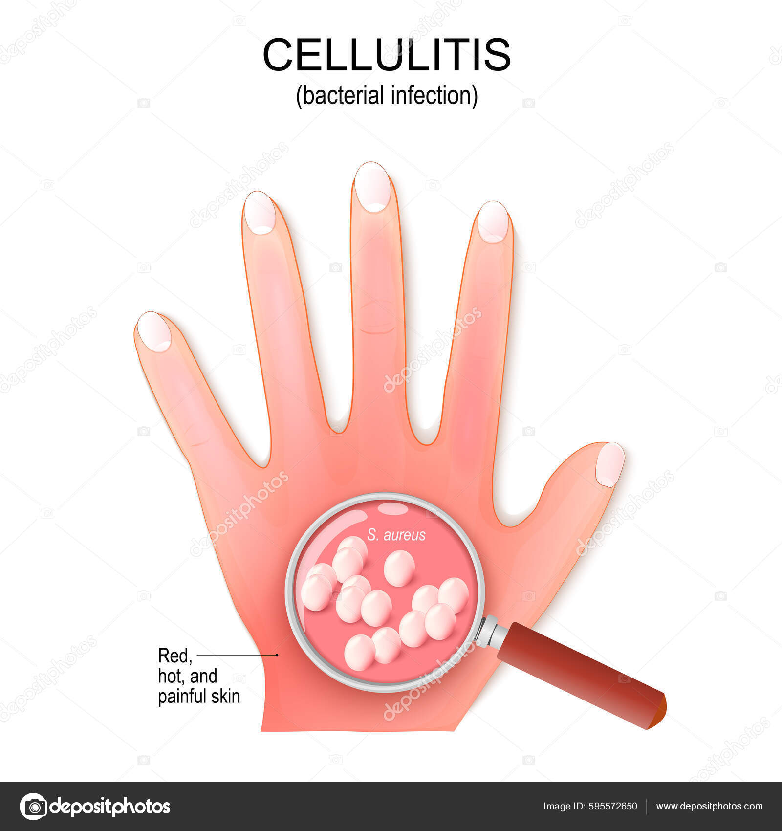 Image vectorielle Cellulitis Humans Palm Bacterial Infection Close ...