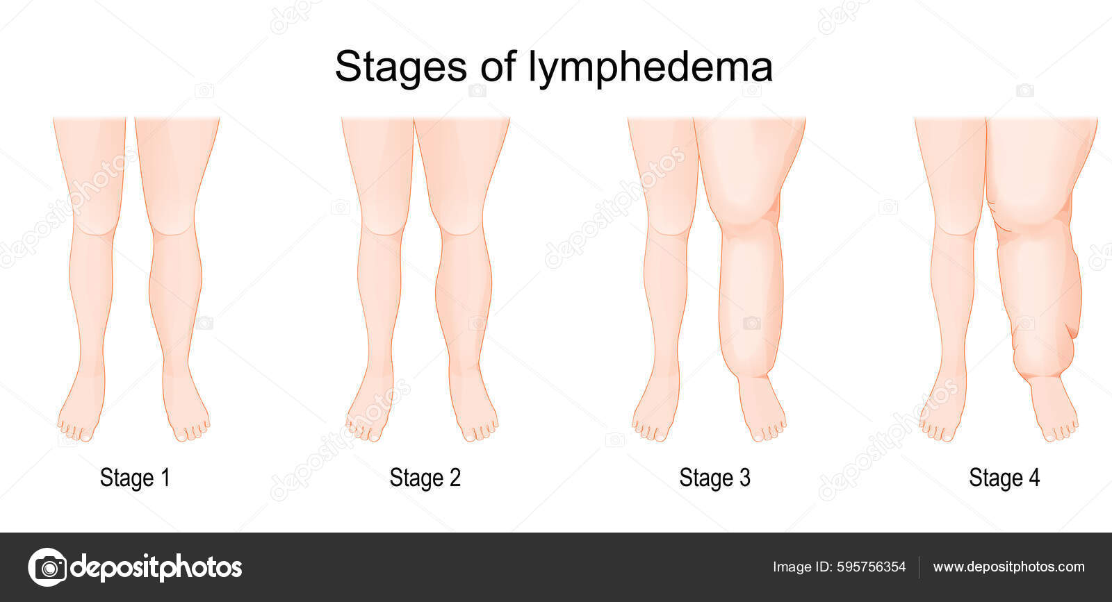 Severity Lower Extremity Lymphedema Different Stages Vector ...