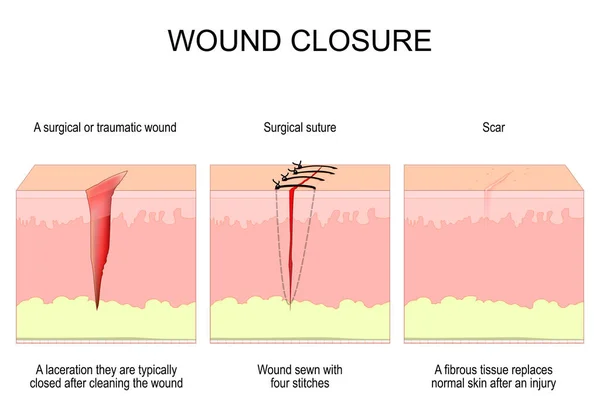 Wound closed Vector Images | Depositphotos