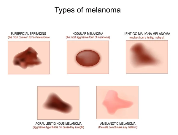 Types of skin cancer. Superficial spreading melanoma, Lentigo maligna ...
