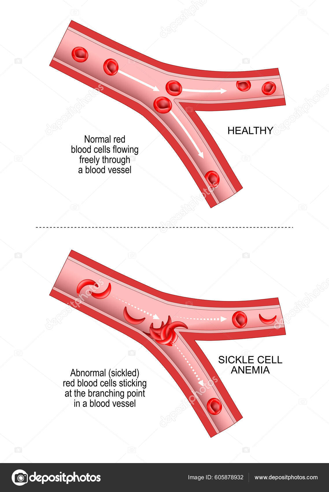 Sickle Cell Disease Scd Disorder Inherited Person's Parents Anaemia ...