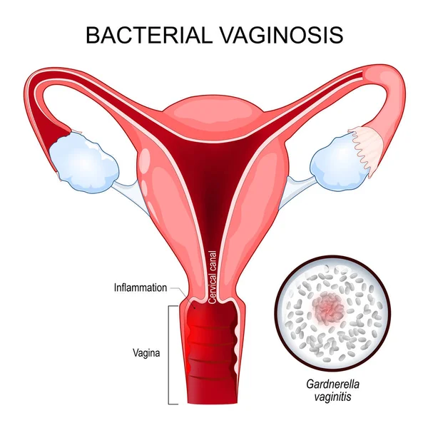 Bacterial vaginosis imágenes de stock de arte vectorial | Depositphotos