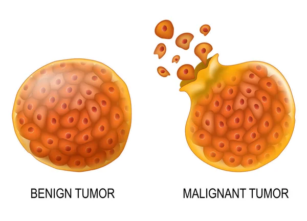 Cancer Neoplasm Comparison Difference Malignant Benign Tumor Benign ...