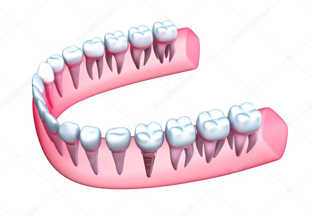 Human jaw model with teeth and implant. — Stock Photo © Alexmit #20583787