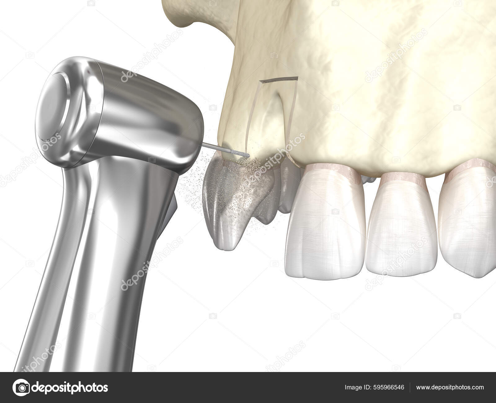 Bone Grafting Augmentation Using Block Bone Tooth Implantation ...