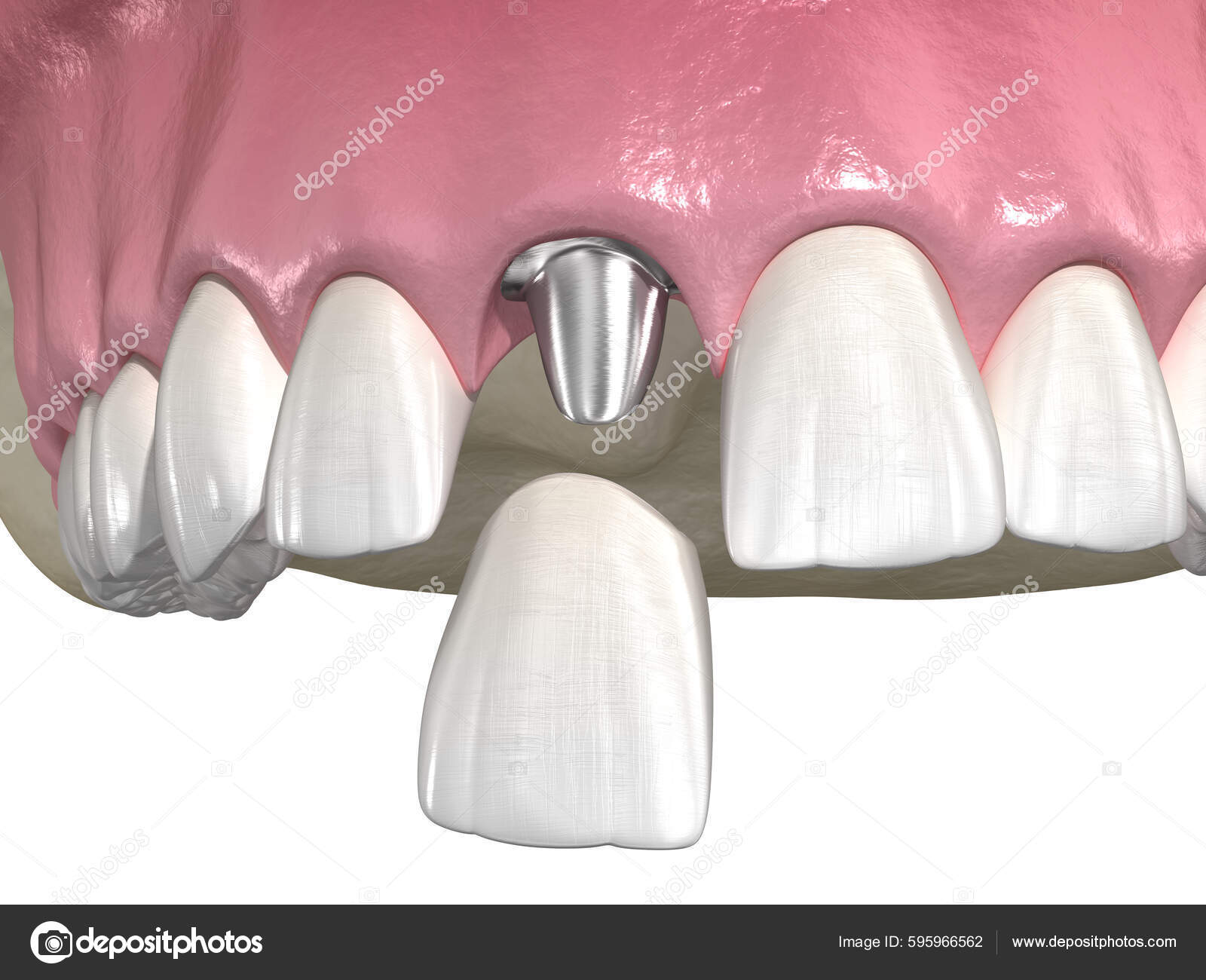 Custom Abutment Dental Implant Ceramic Crown Medically Accurate Tooth ...