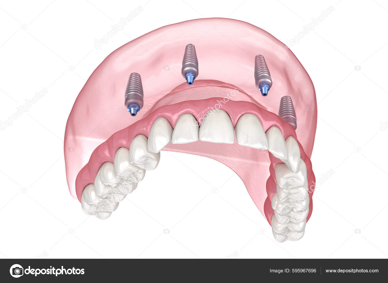 Maxillary Prosthesis Gum All System Supported Implants Medically ...