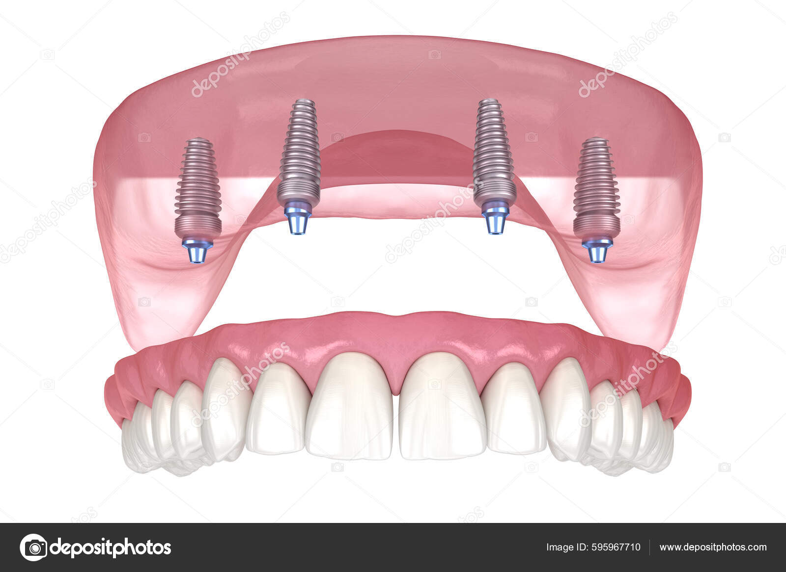 Maxillary Prosthesis Gum All System Supported Implants Medically ...