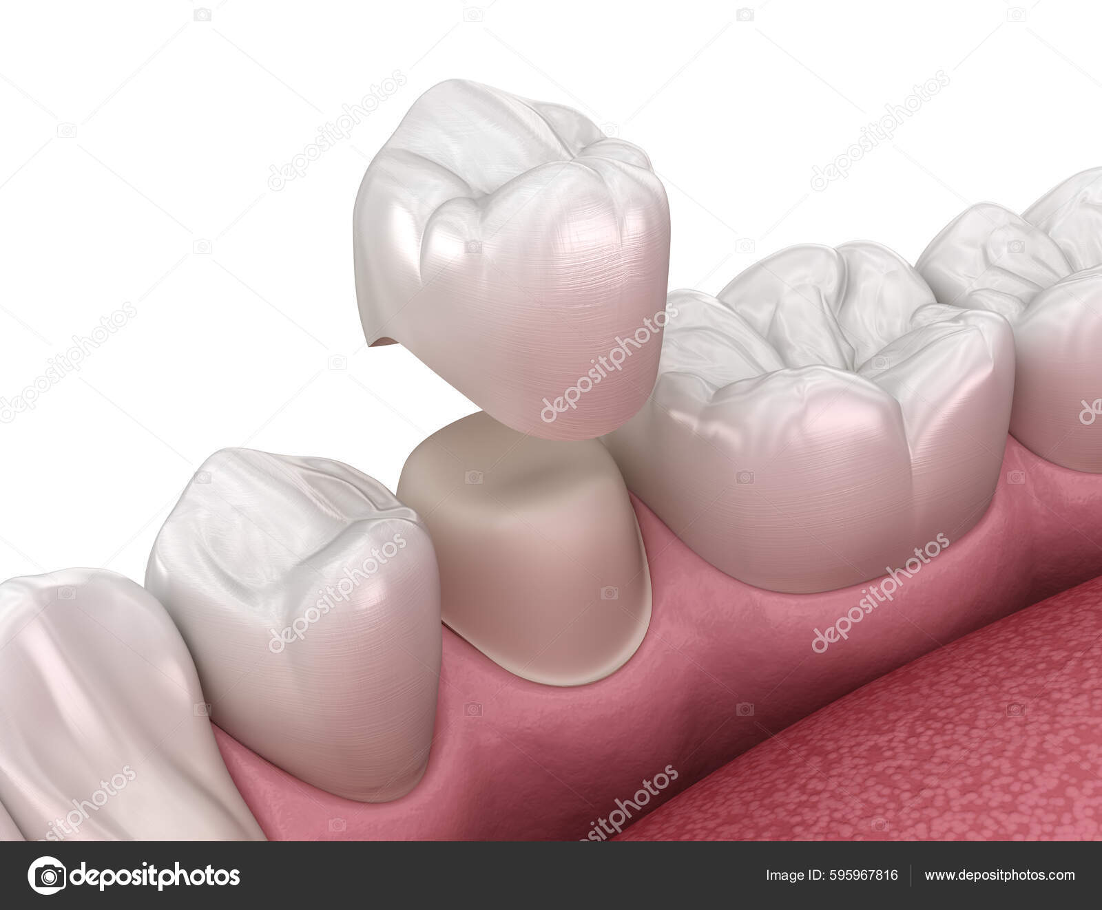 Preparato Dente Premolare Posizionamento Corona Dentale Illustrazione Clinicamente Accurata ...