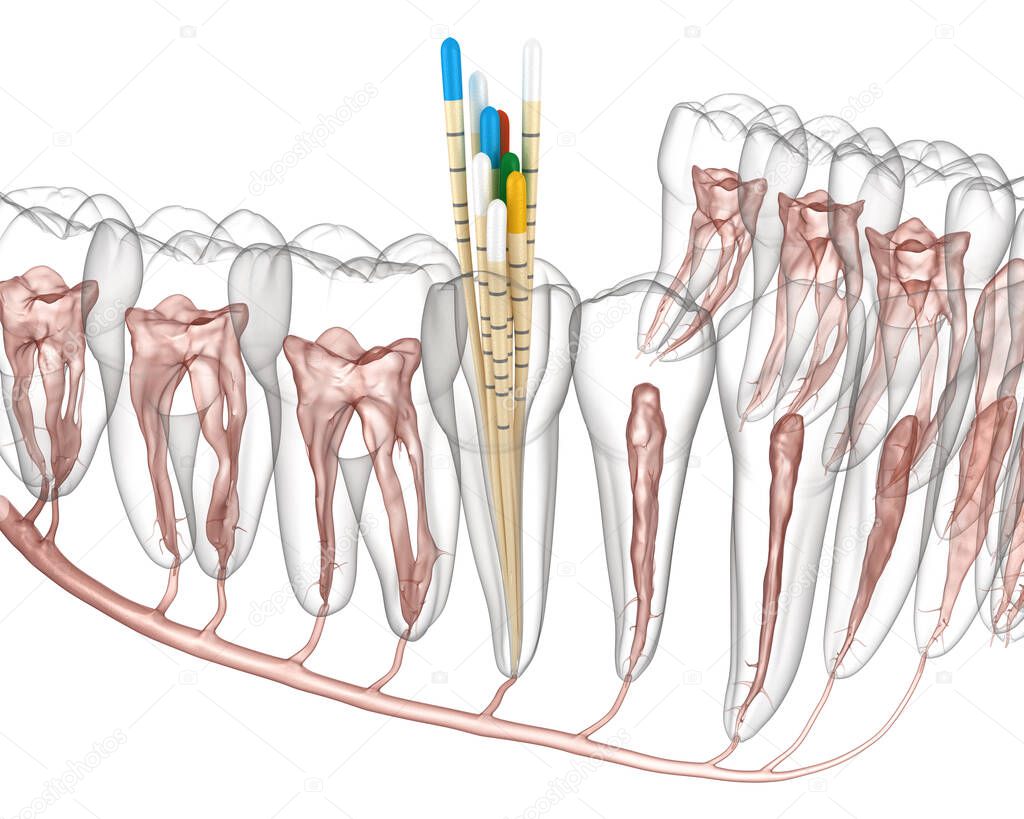 Tratamiento endodóntico del conducto radicular. Ilustración 3D de ...