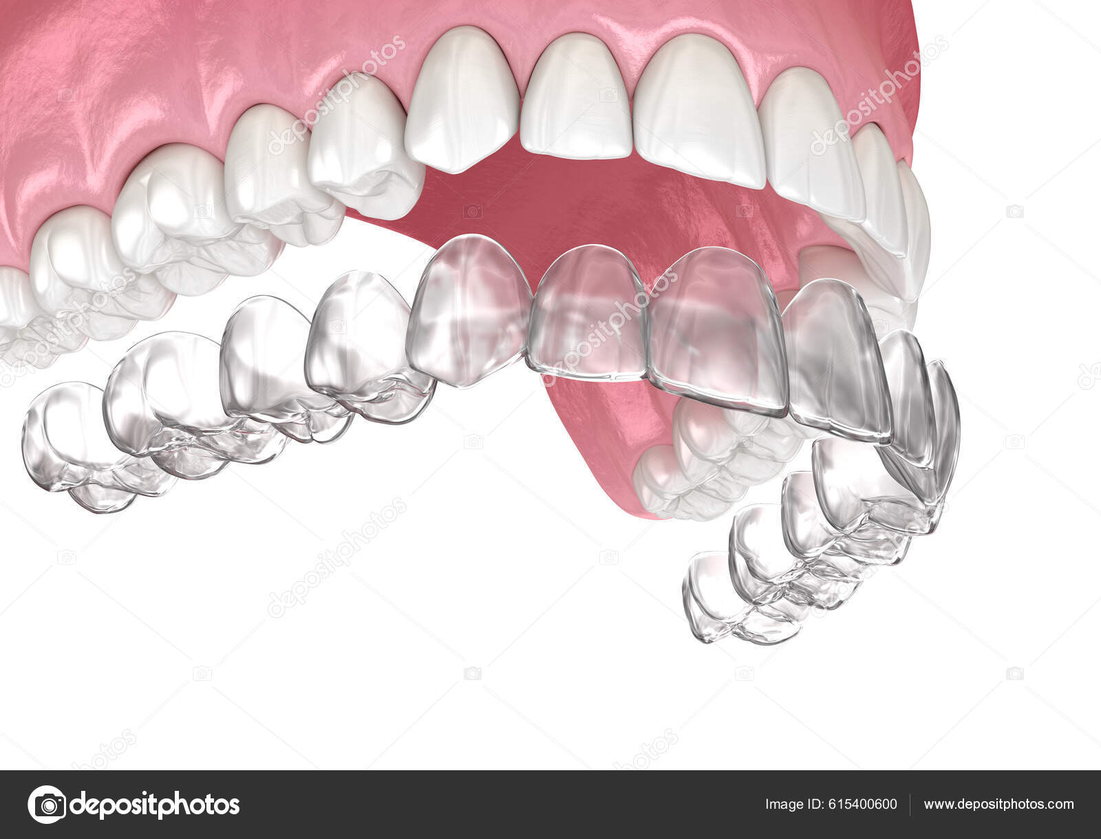 Tanda Kurung Tak Terlihat Atau Penahan Tak Terlihat Ilustrasi Gigi ...