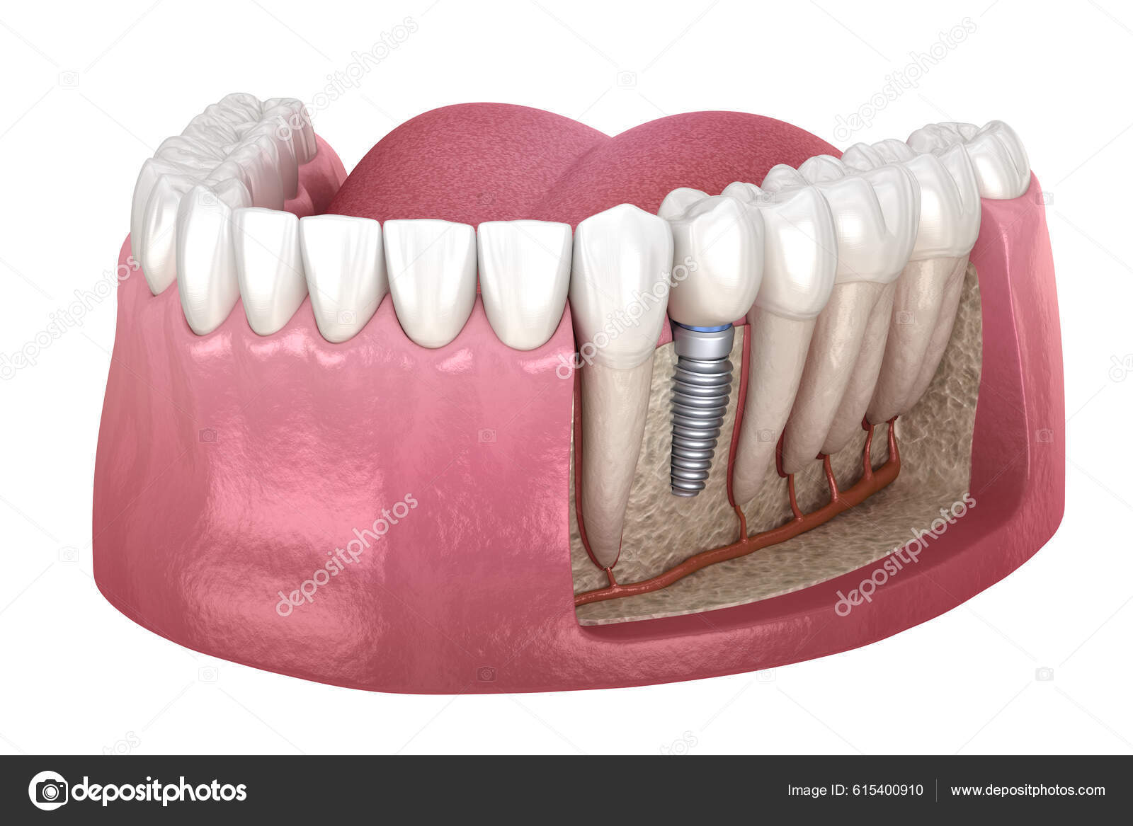Premolar Tooth Crown Installation Implant Abutment Medically Accurate ...
