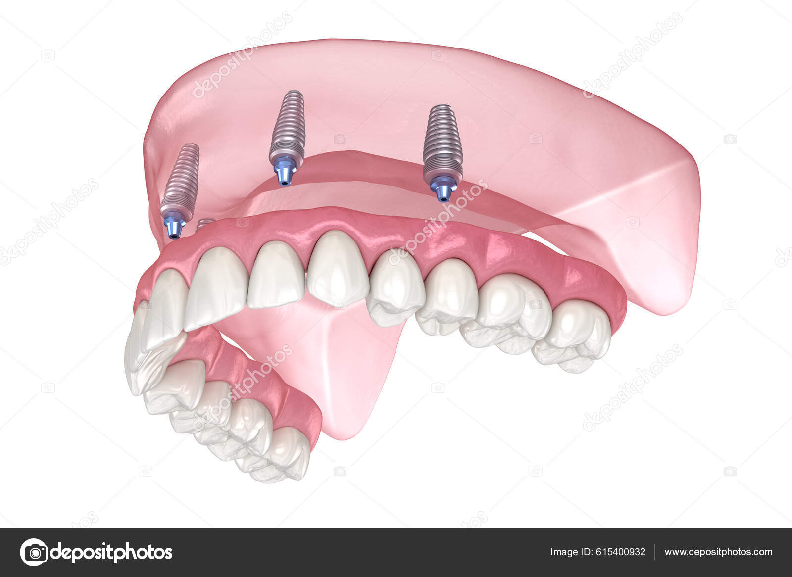 Maxillary Prosthesis Gum All System Supported Implants Medically ...