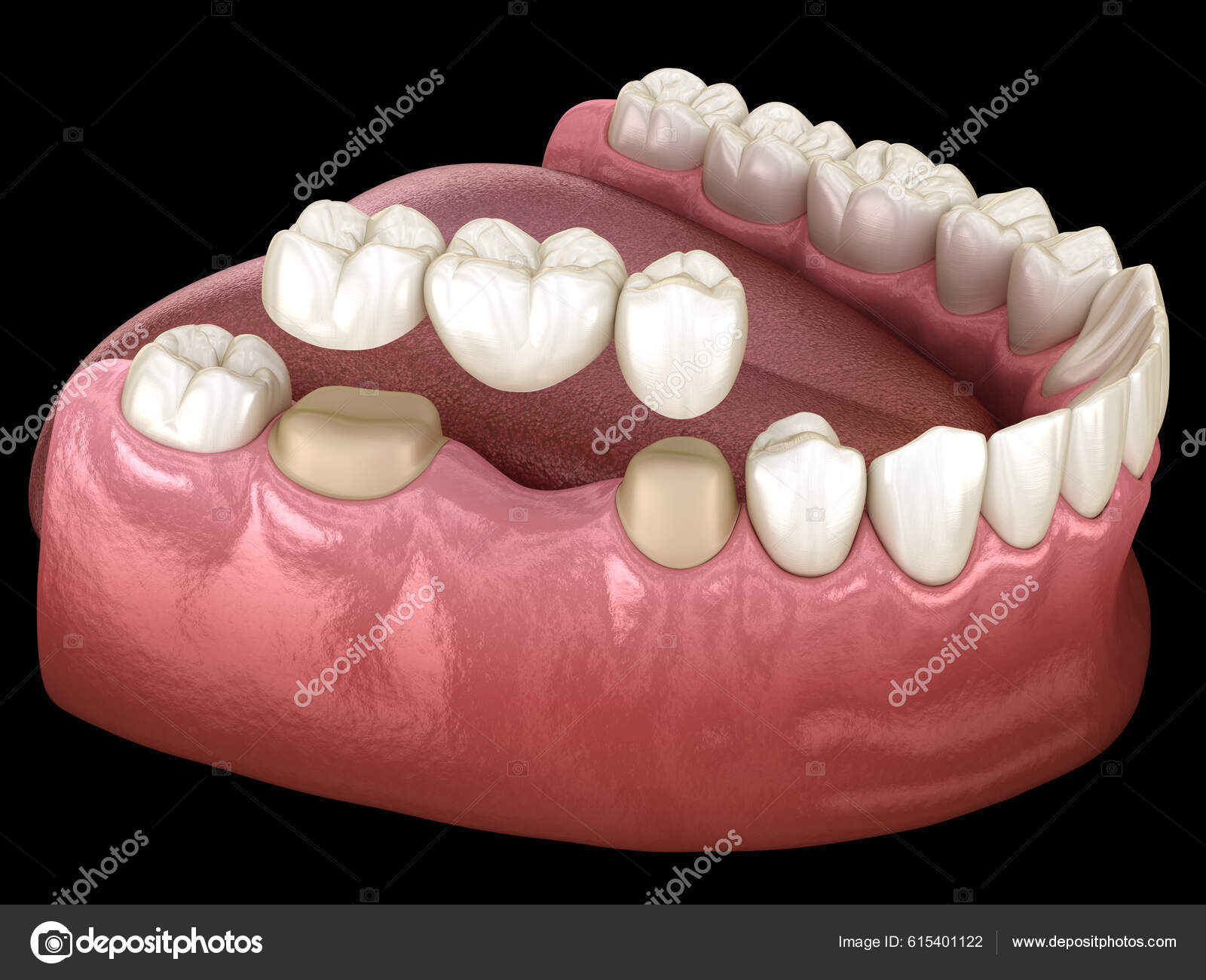 Preparated Molar Premolar Tooth Dental Bridge Placement Medically ...
