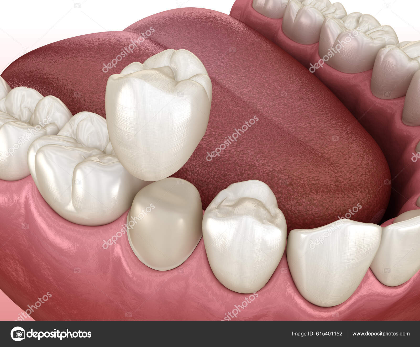 Preparated Premolar Tooth Dental Crown Placement Medically Accurate ...