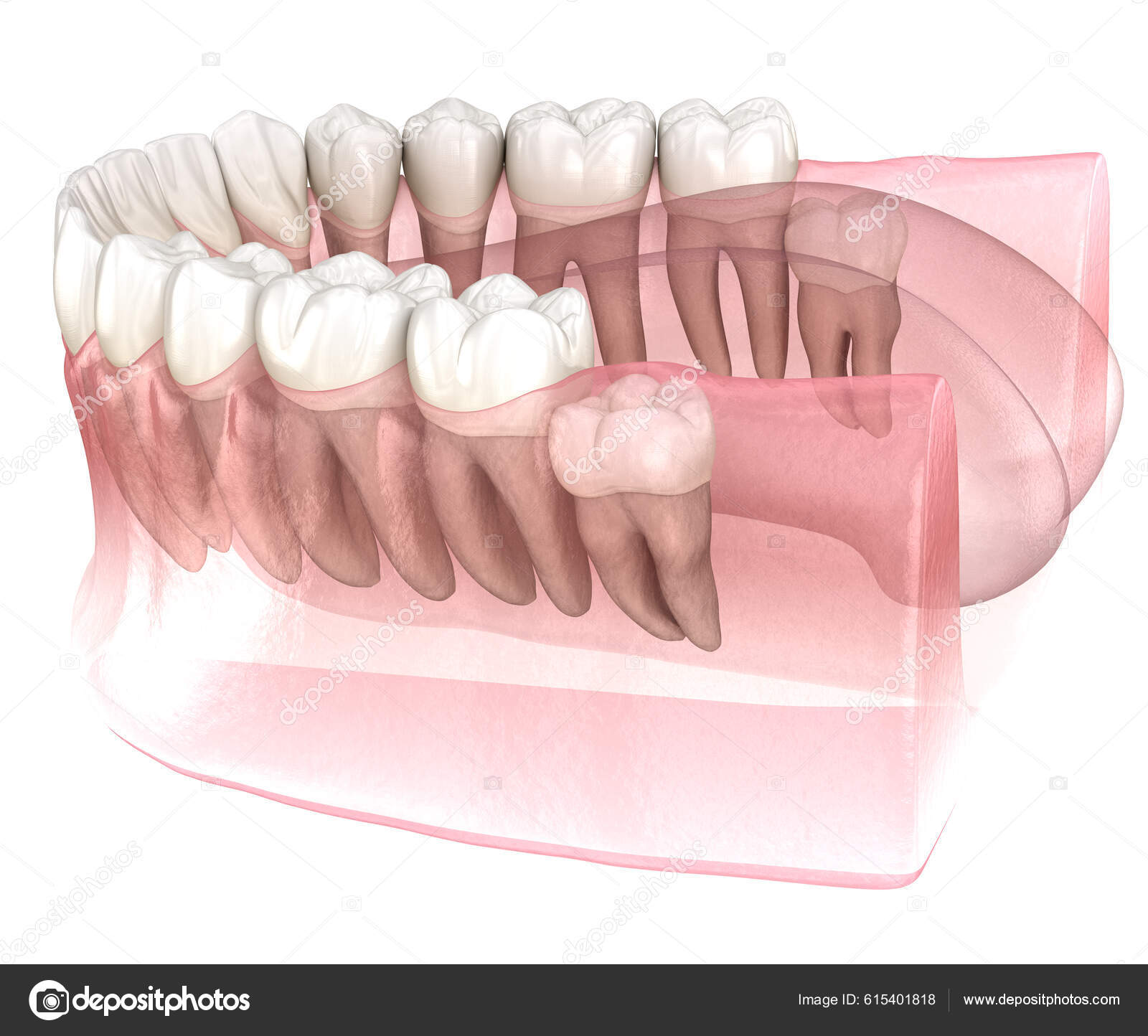 Vertikaler Aufprall Des Weisheitszahns Medizinisch Korrekte Darstellung ...