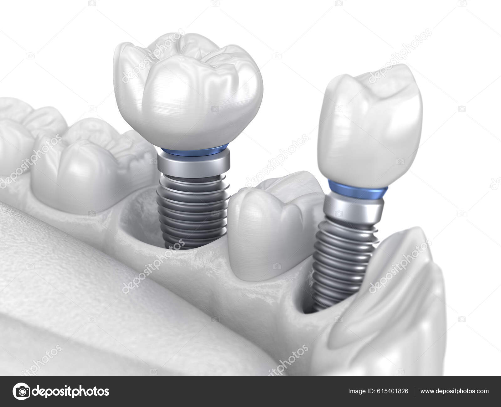 Premolar Molar Tooth Crown Installation Implant White Concept ...